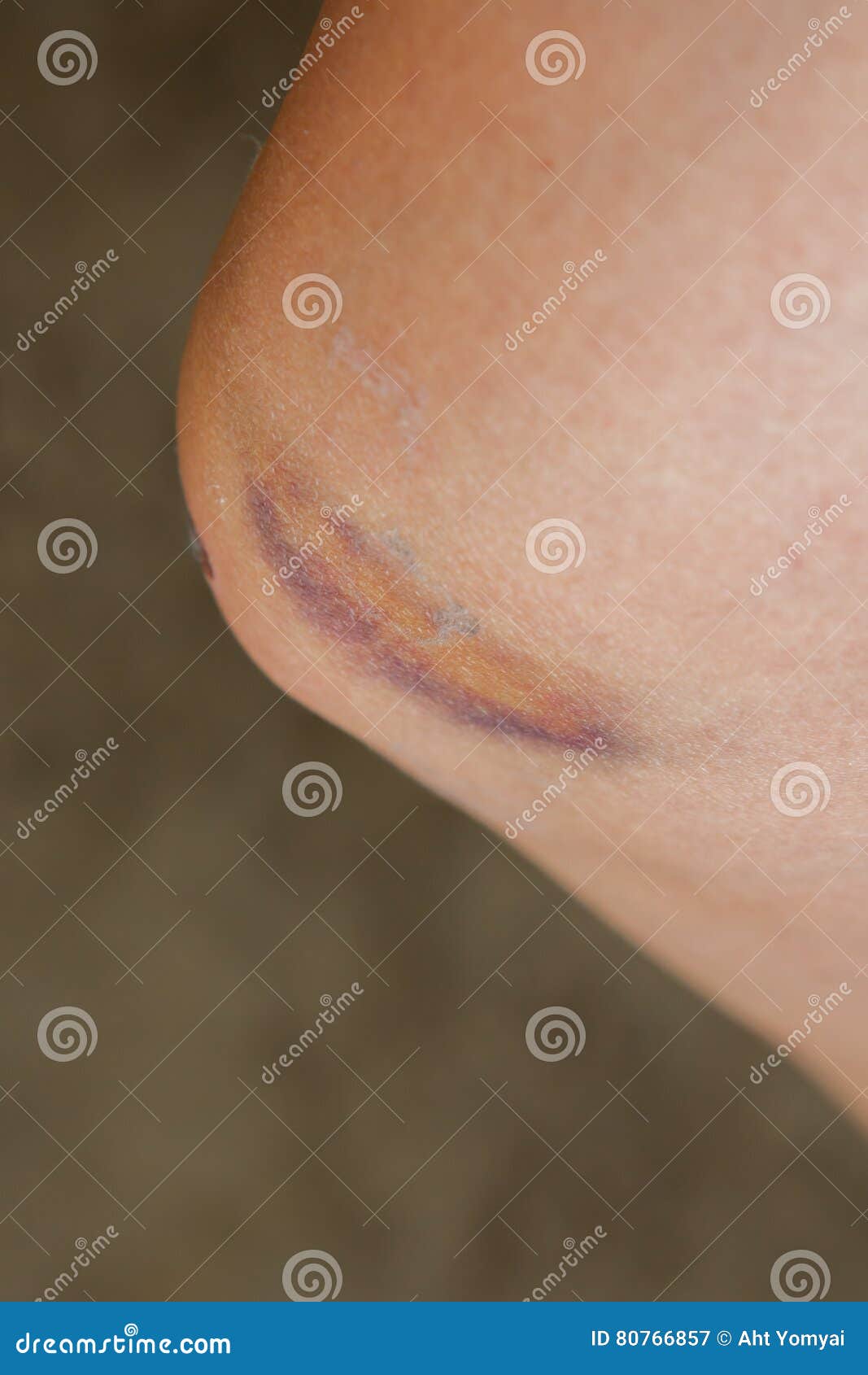Scratch on the knee. stock image. Image of injury, hygiene - 80766857