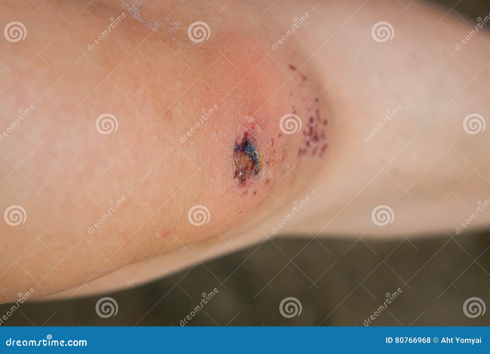 Scratch on the knee. stock photo. Image of ache, emergency - 80766968