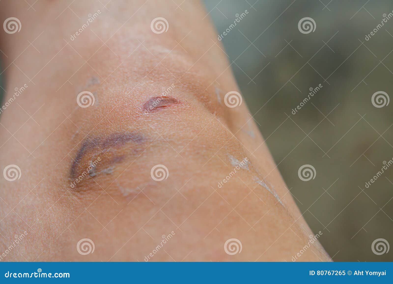 Scratch on the knee. stock image. Image of ache, inflamed - 80767265