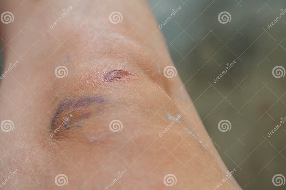 Scratch on the knee. stock image. Image of ache, inflamed - 80767265