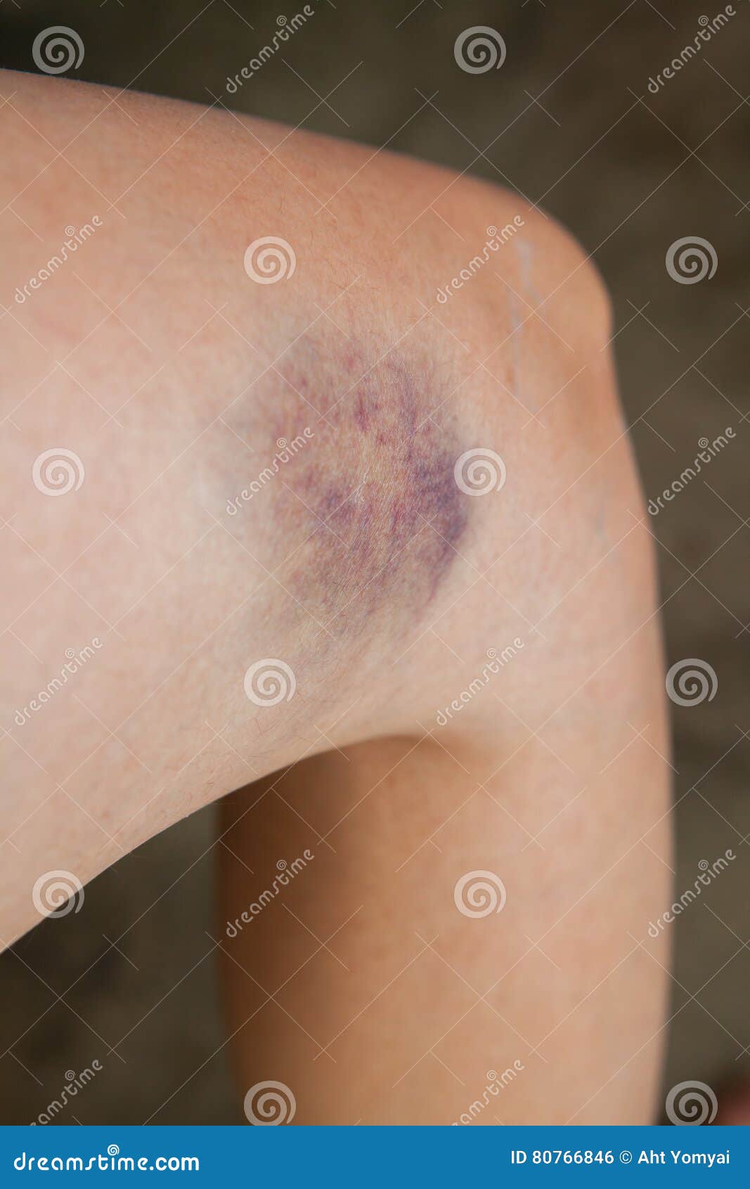 Scratch on the knee. stock photo. Image of human, emergency - 80766846