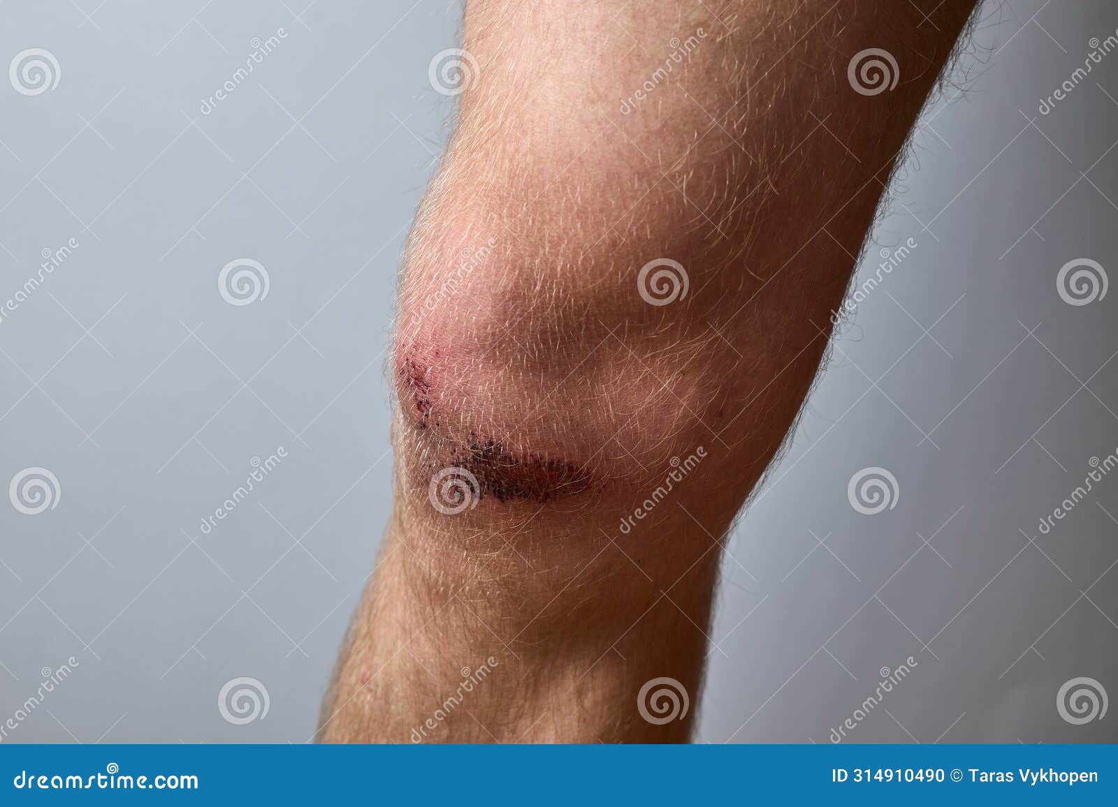 Scratch, Knee Wound on a Man& X27;s Knee Stock Photo - Image of ...