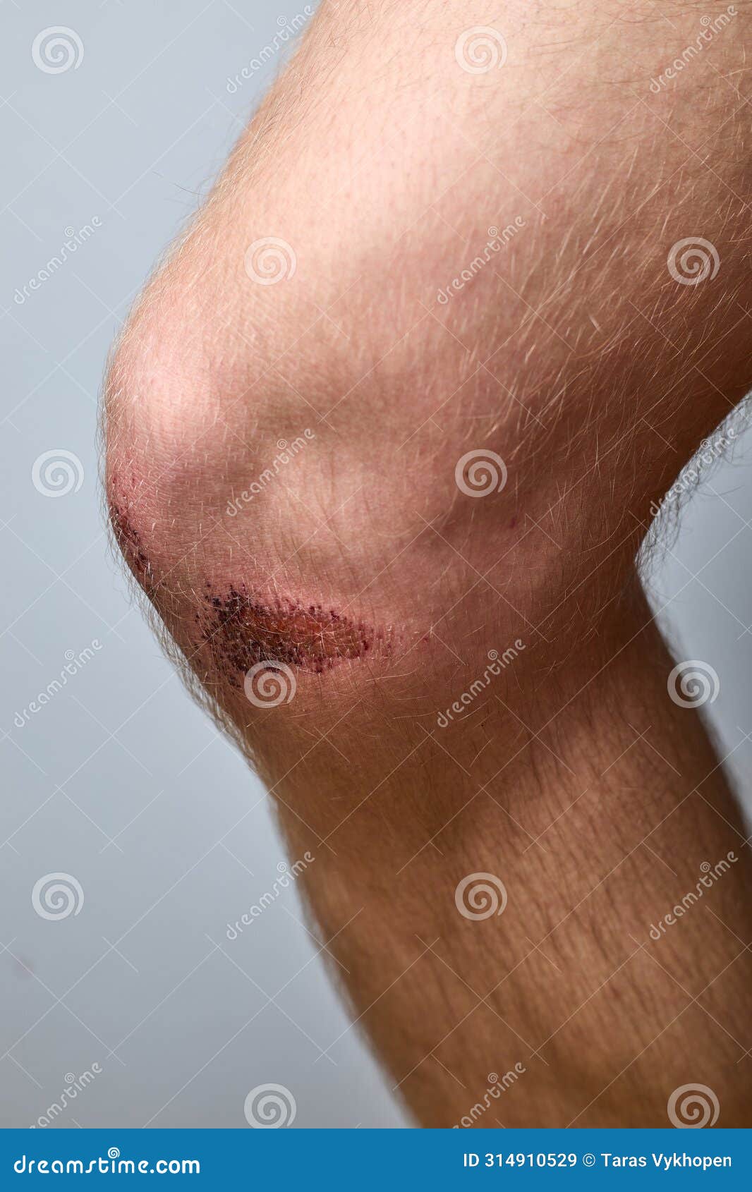 Scratch, Knee Wound on a Man& X27;s Knee Stock Image - Image of people ...