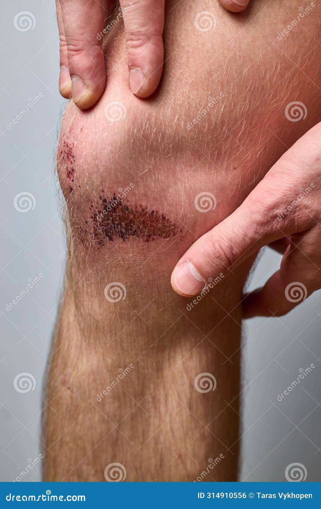Scratch, Knee Wound on a Man& X27;s Knee Stock Photo - Image of ...