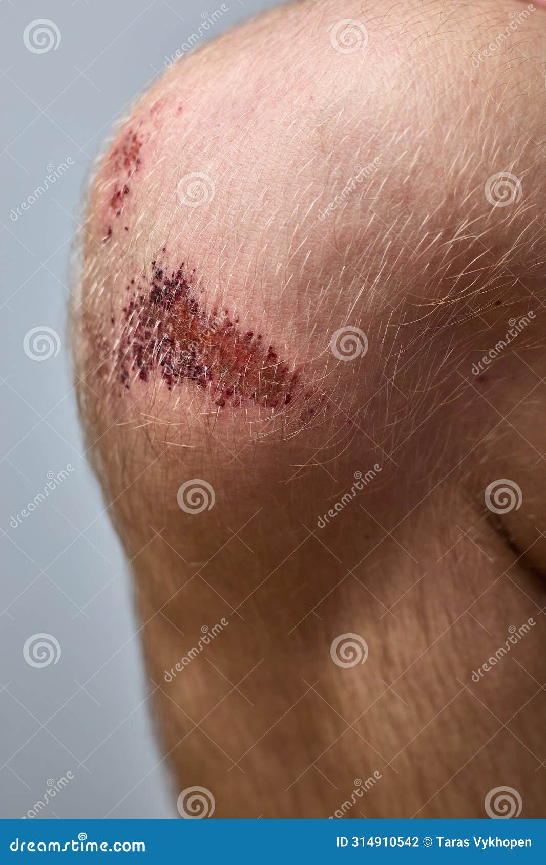 Scratch, Knee Wound on a Man& X27;s Knee Stock Photo - Image of ...