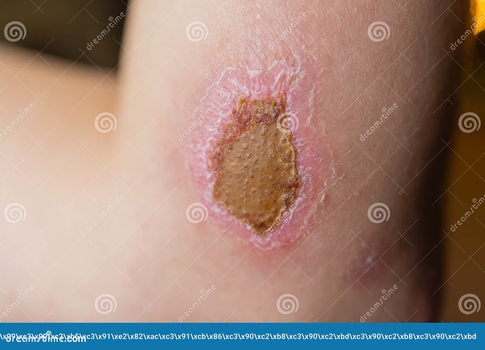 Scratch Lesion Caused by the Accident on Leg Skin. Stock Photo - Image ...