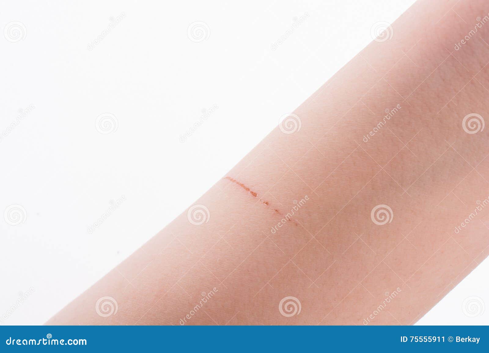 Scratch Scar In Hand Royalty-Free Stock Photography | CartoonDealer.com ...