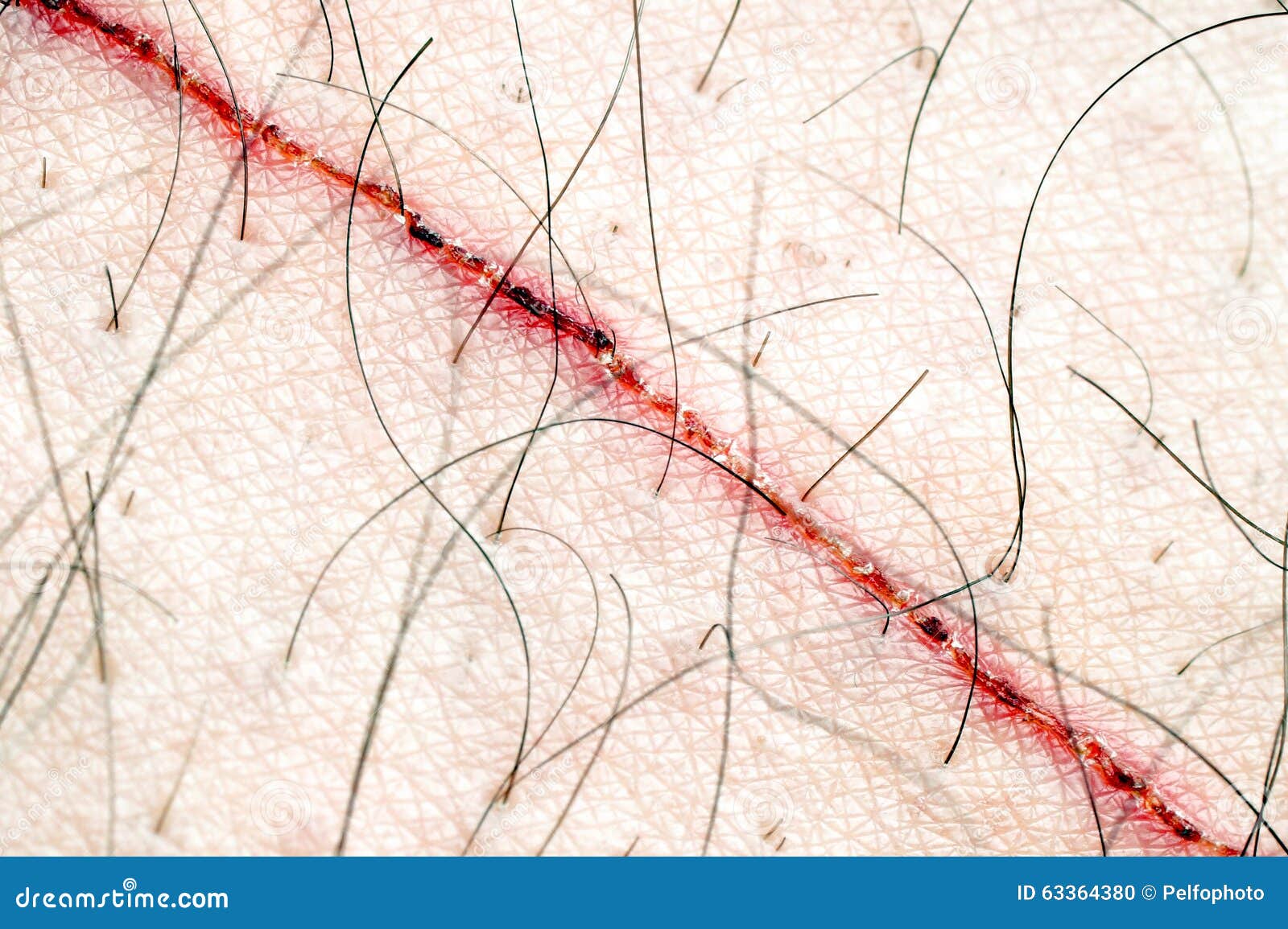 Scratch on the skin. stock photo. Image of cure, closeup - 63364380