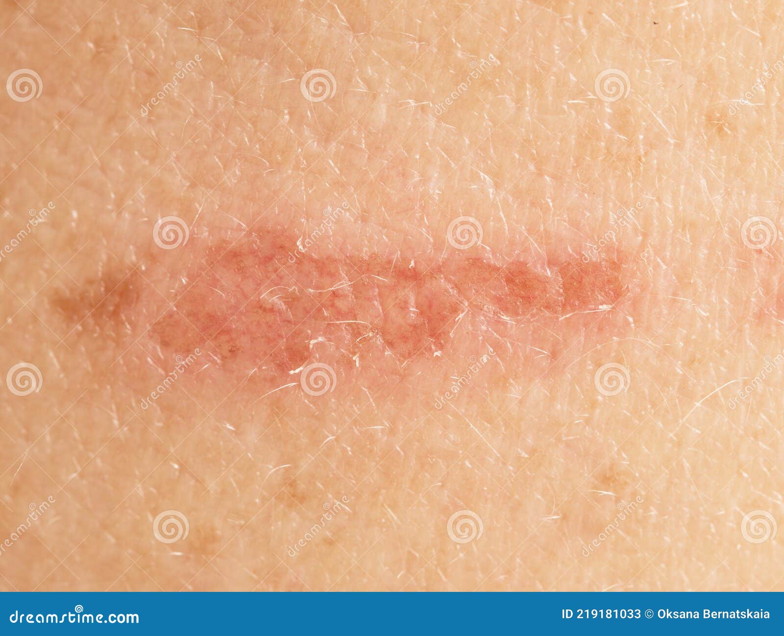 Scratch on the Skin Close-up Stock Image - Image of health, macro ...