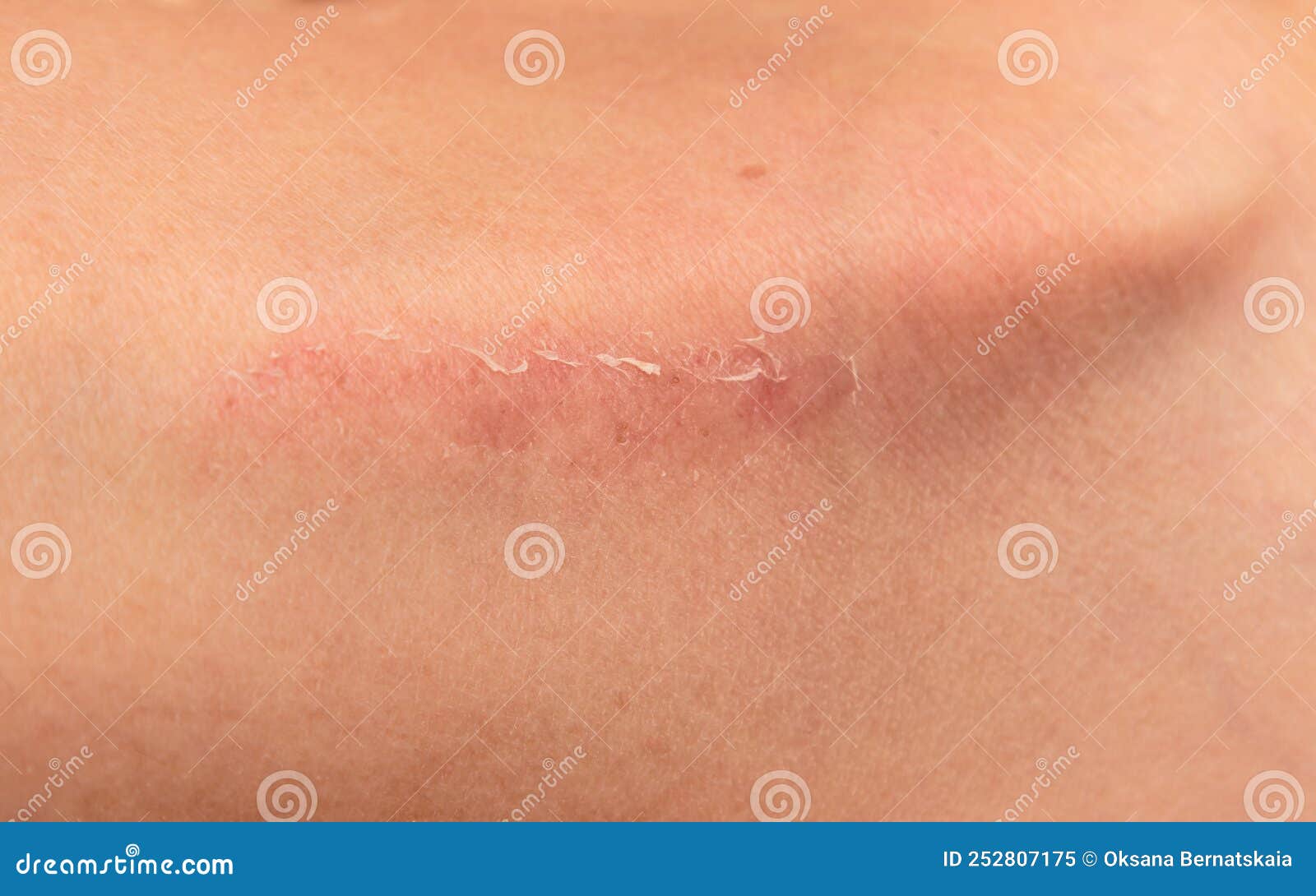 Scratch on the Skin of the Leg As a Background Stock Image - Image of ...