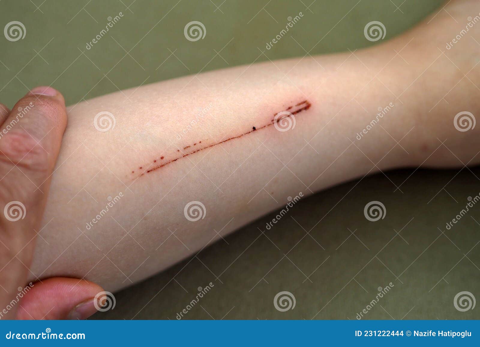 A Scratch Wound that Forms a Trace on the Leg, the Child`s Leg is ...