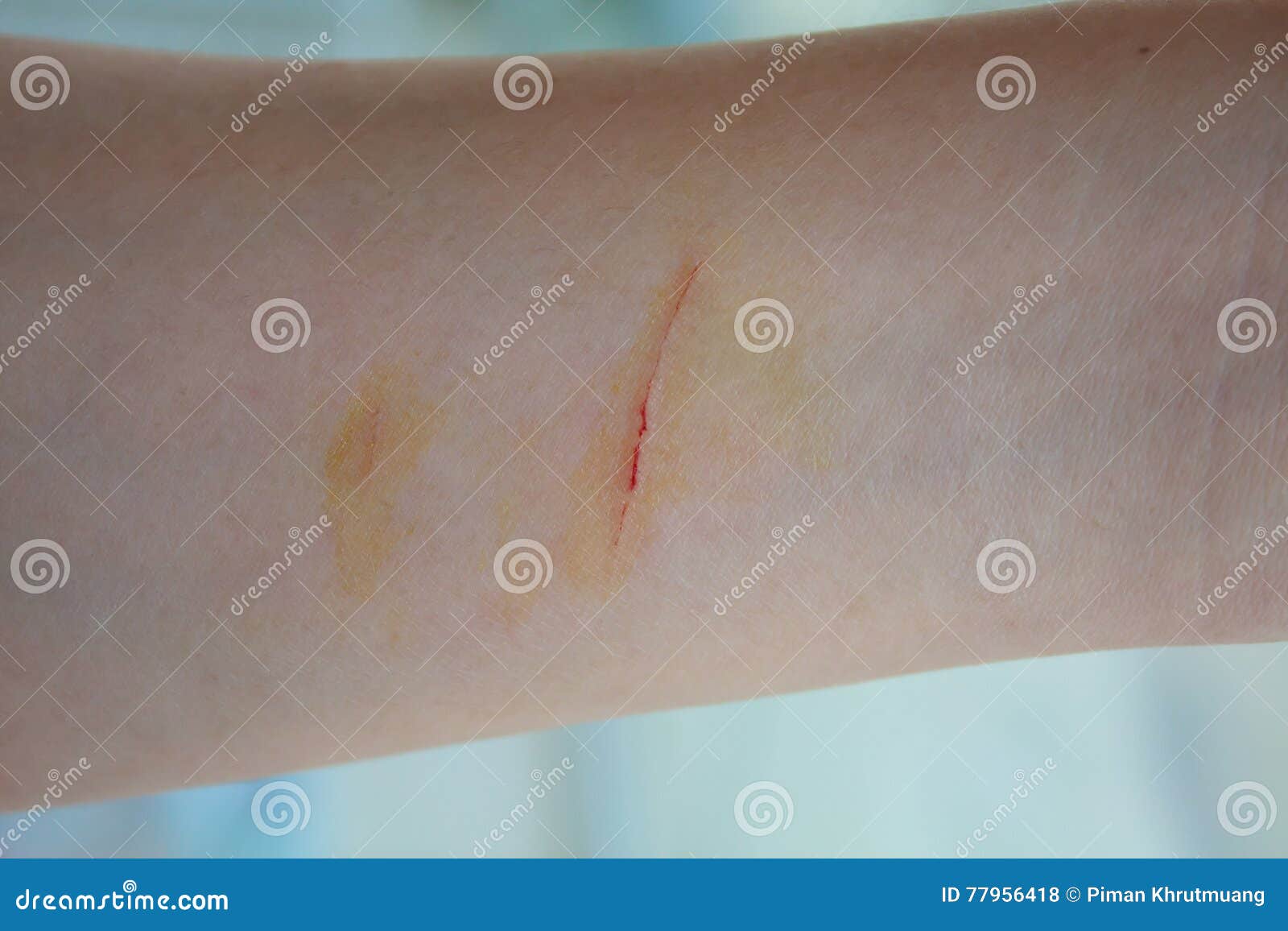 Scratched wound on arm stock photo. Image of medical - 77956418