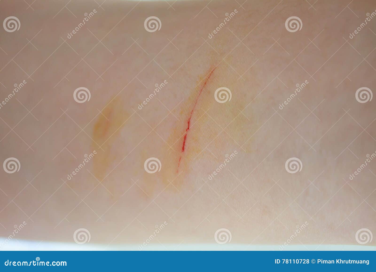 Scratched wound on arm stock photo. Image of hurt, medical - 78110728