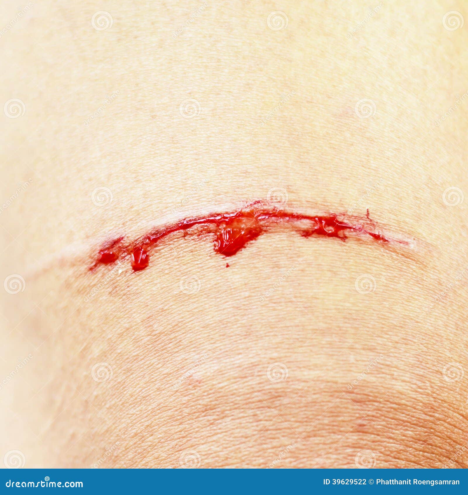 Scratched wound on leg stock photo. Image of care, skin - 39629522