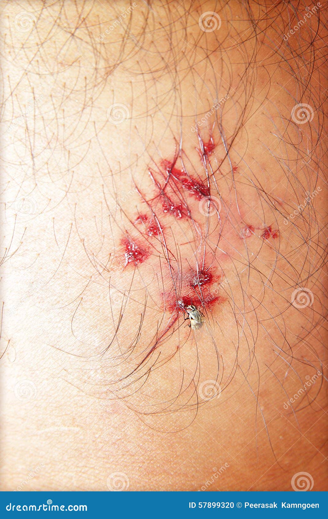 Scratched Wound on Leg, Fresh Wounds Stock Photo - Image of hair ...
