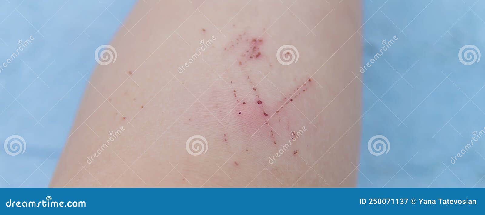 Scratches on a Child S Leg. Selective Focus Stock Image - Image of ...