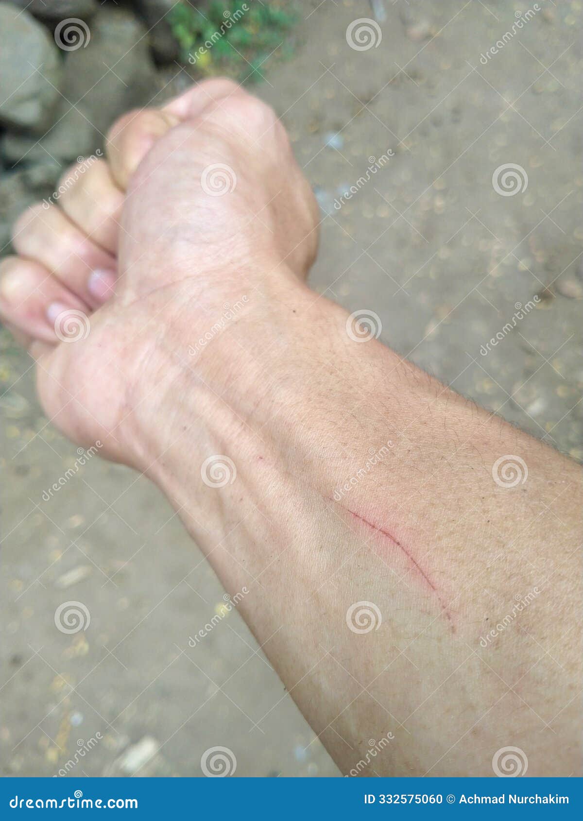 Scratch scars stock photo. Image of scars, person, skin - 332575060