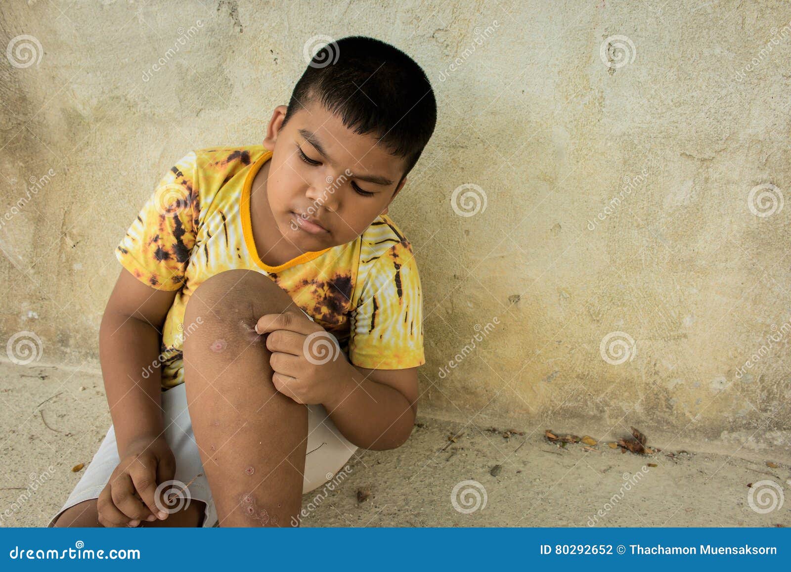 Scratching the Blisters Scab on Leg Stock Photo - Image of health ...