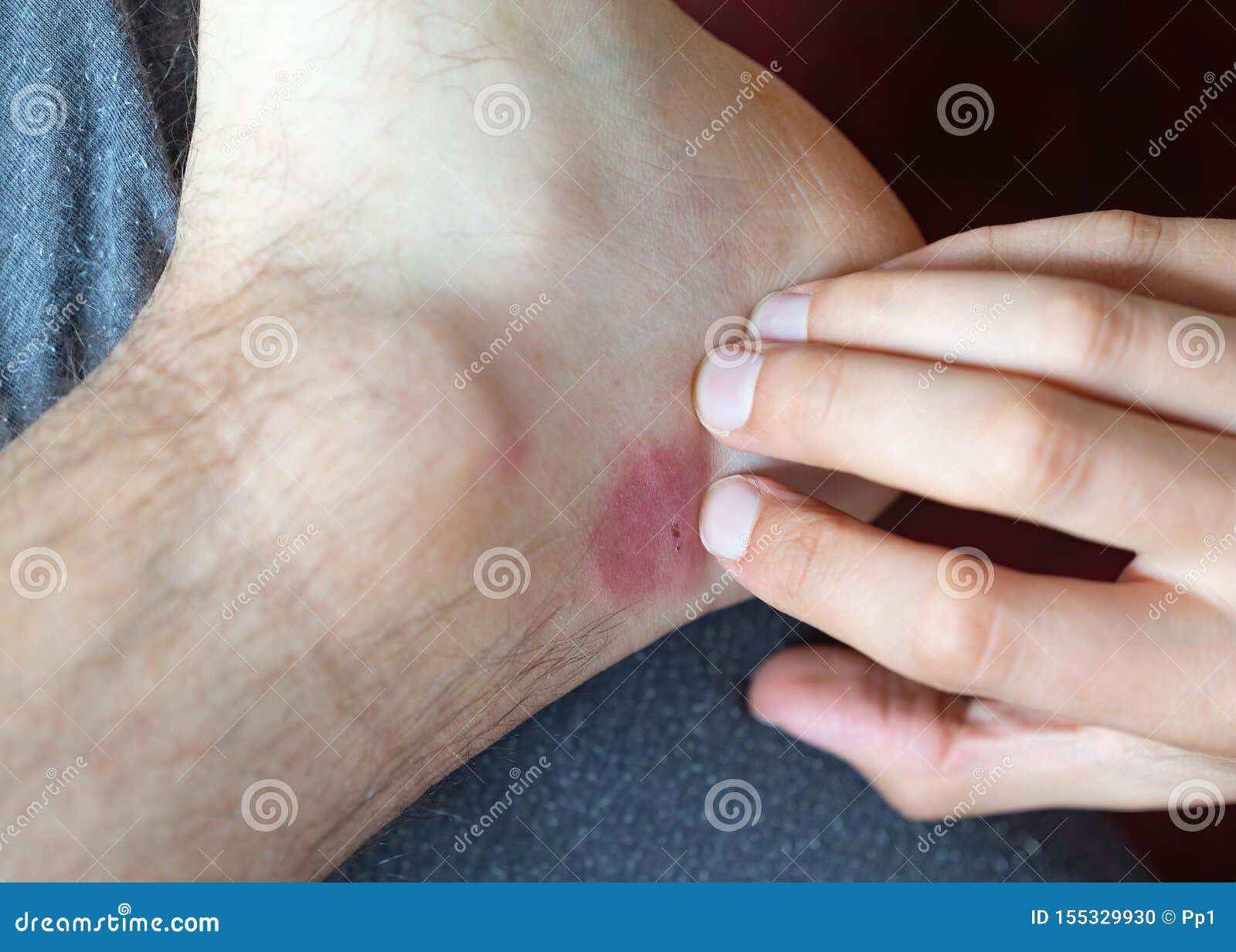 Scratching Insect Flea Bite Body Chest Foot By Hand Itch Stock Image ...