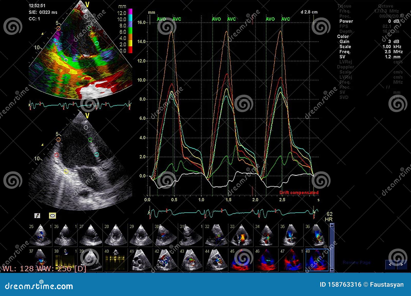 Screen of Echocardiography Ultrasound Machine Stock Photo - Image of ...