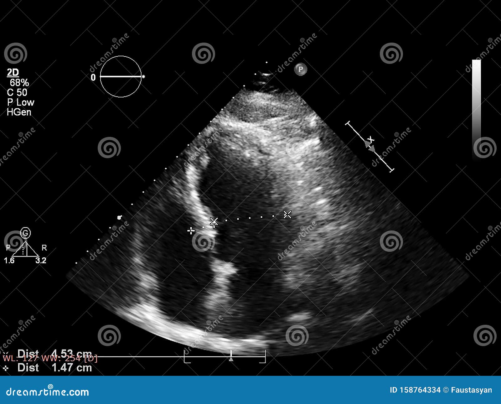 Screen of Echocardiography Ultrasound Machine Stock Photo - Image of ...