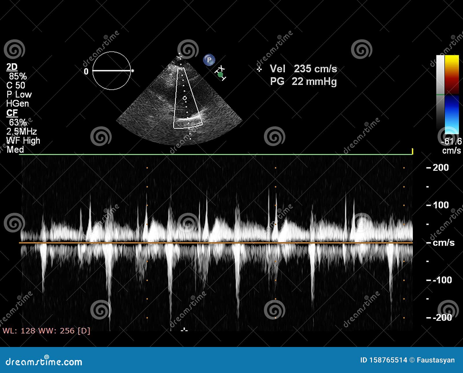Screen of Echocardiography Ultrasound Machine Stock Photo - Image of ...