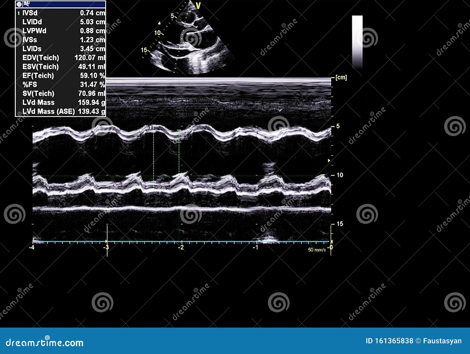Screen of Echocardiography Ultrasound Machine Stock Photo - Image of ...