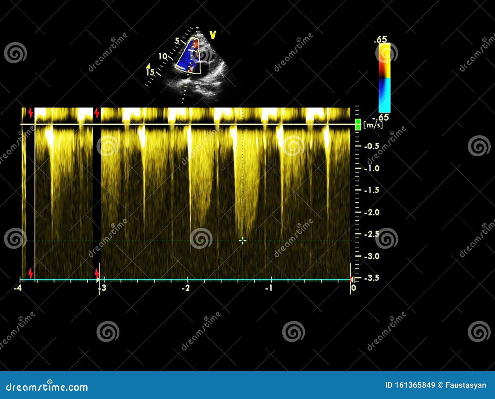 Screen of Echocardiography Ultrasound Machine Stock Image - Image of ...