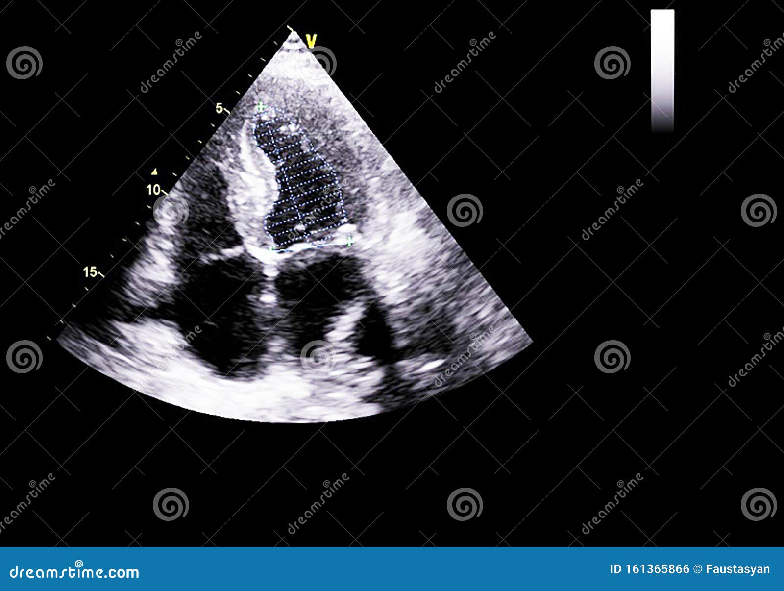Screen of Echocardiography Ultrasound Machine Stock Photo - Image of ...