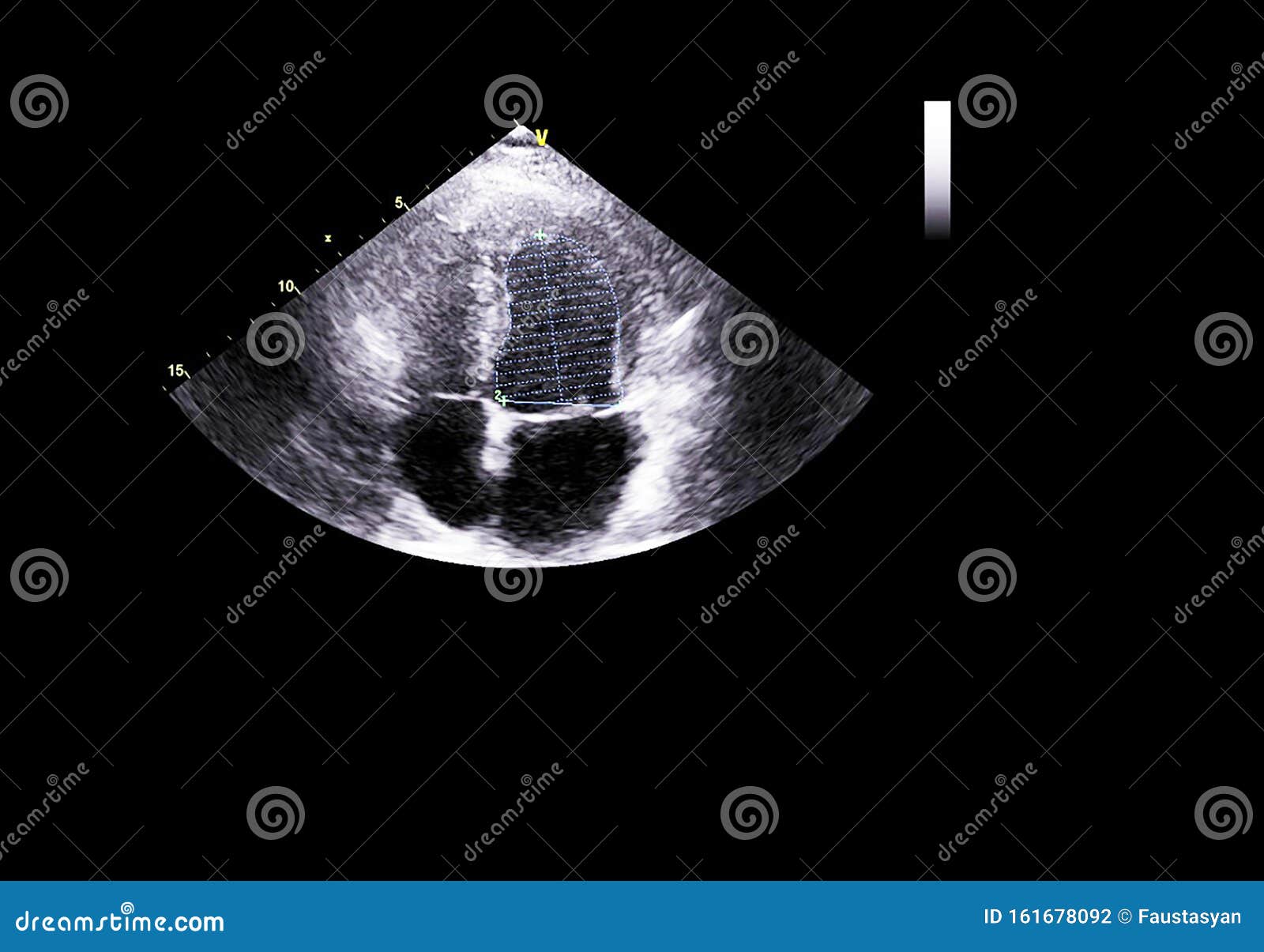 Screen of Echocardiography Ultrasound Machine Stock Photo - Image of ...
