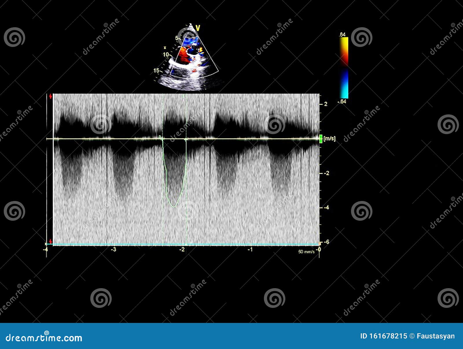 Screen of Echocardiography Ultrasound Machine Stock Image - Image of ...