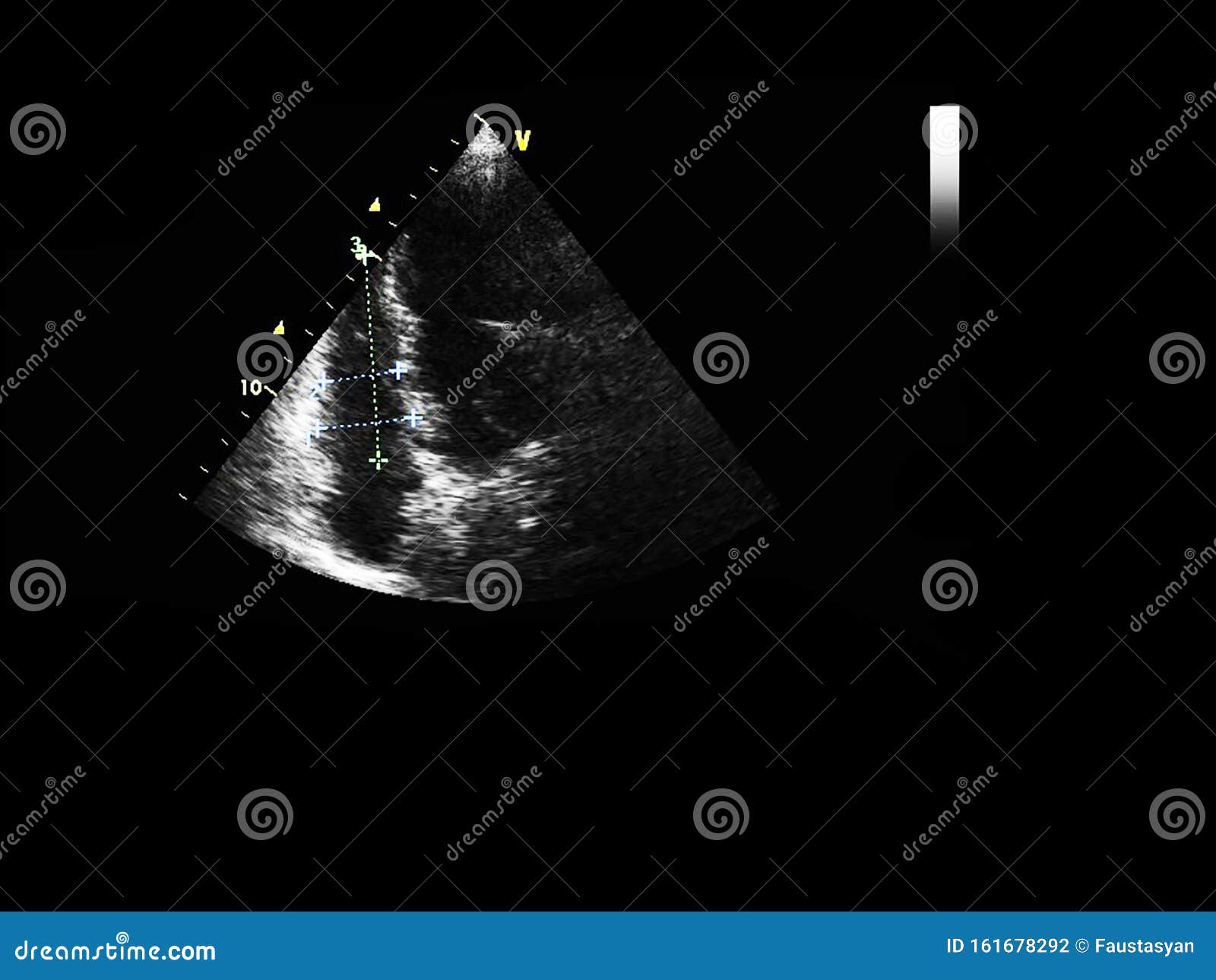 Screen of Echocardiography Ultrasound Machine Stock Photo - Image of ...