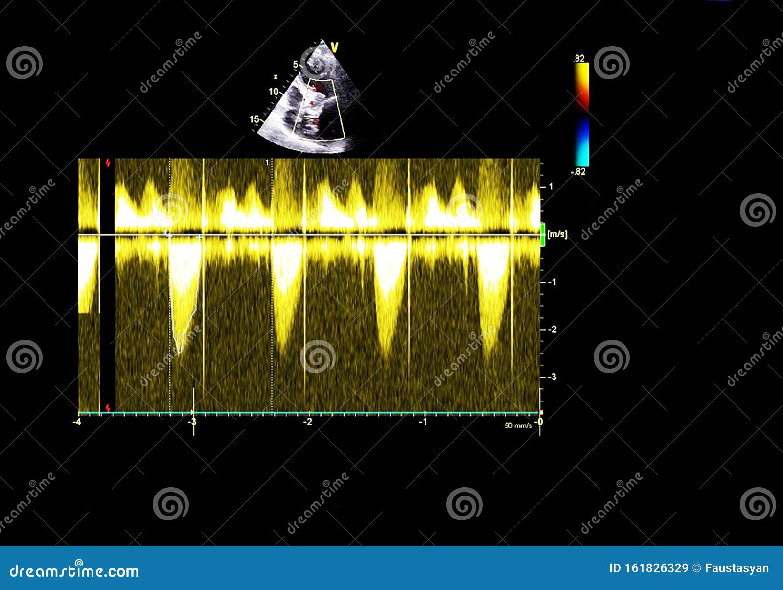 Screen of Echocardiography Ultrasound Machine Stock Image - Image of ...