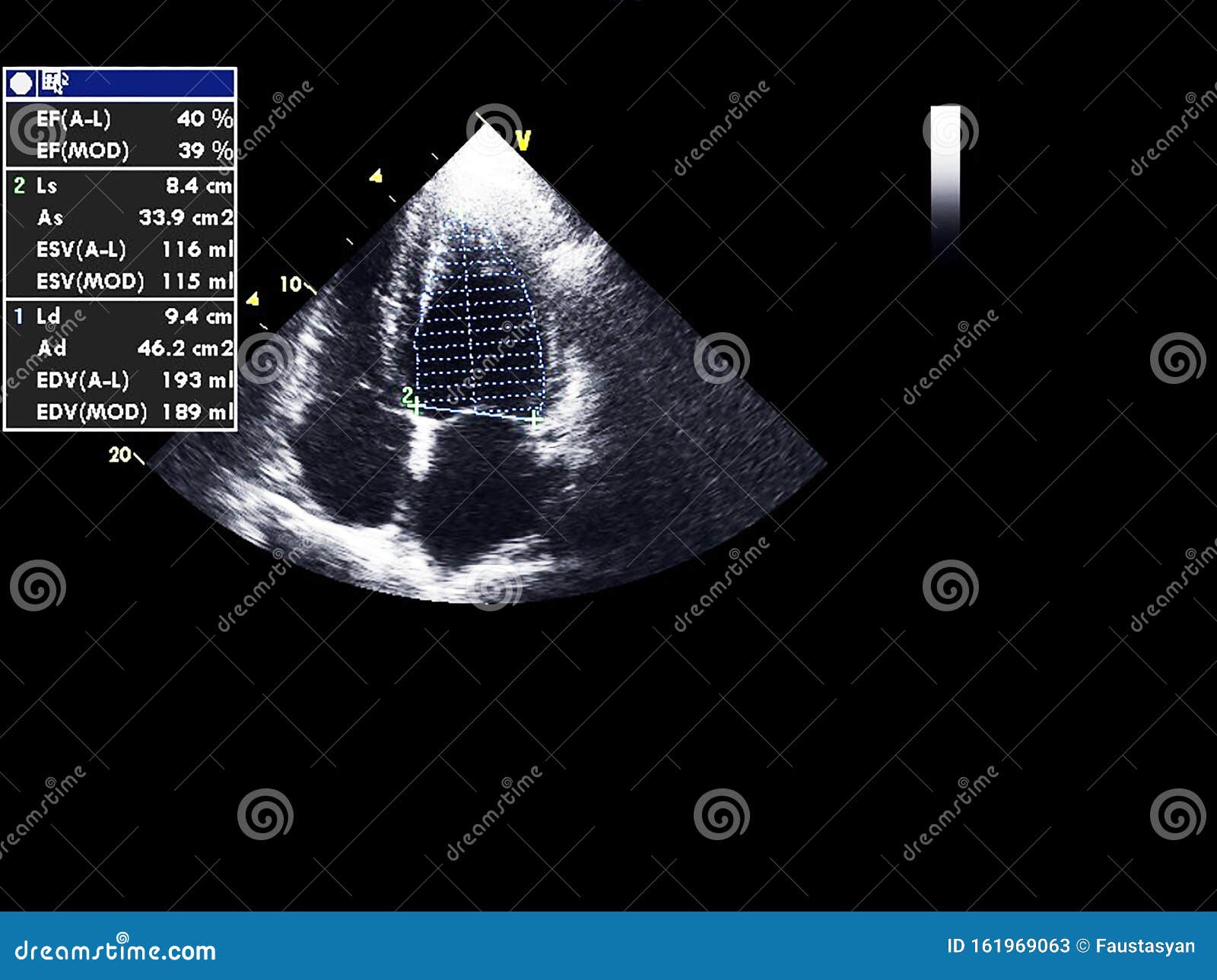 Screen of Echocardiography Ultrasound Machine Stock Image - Image of ...