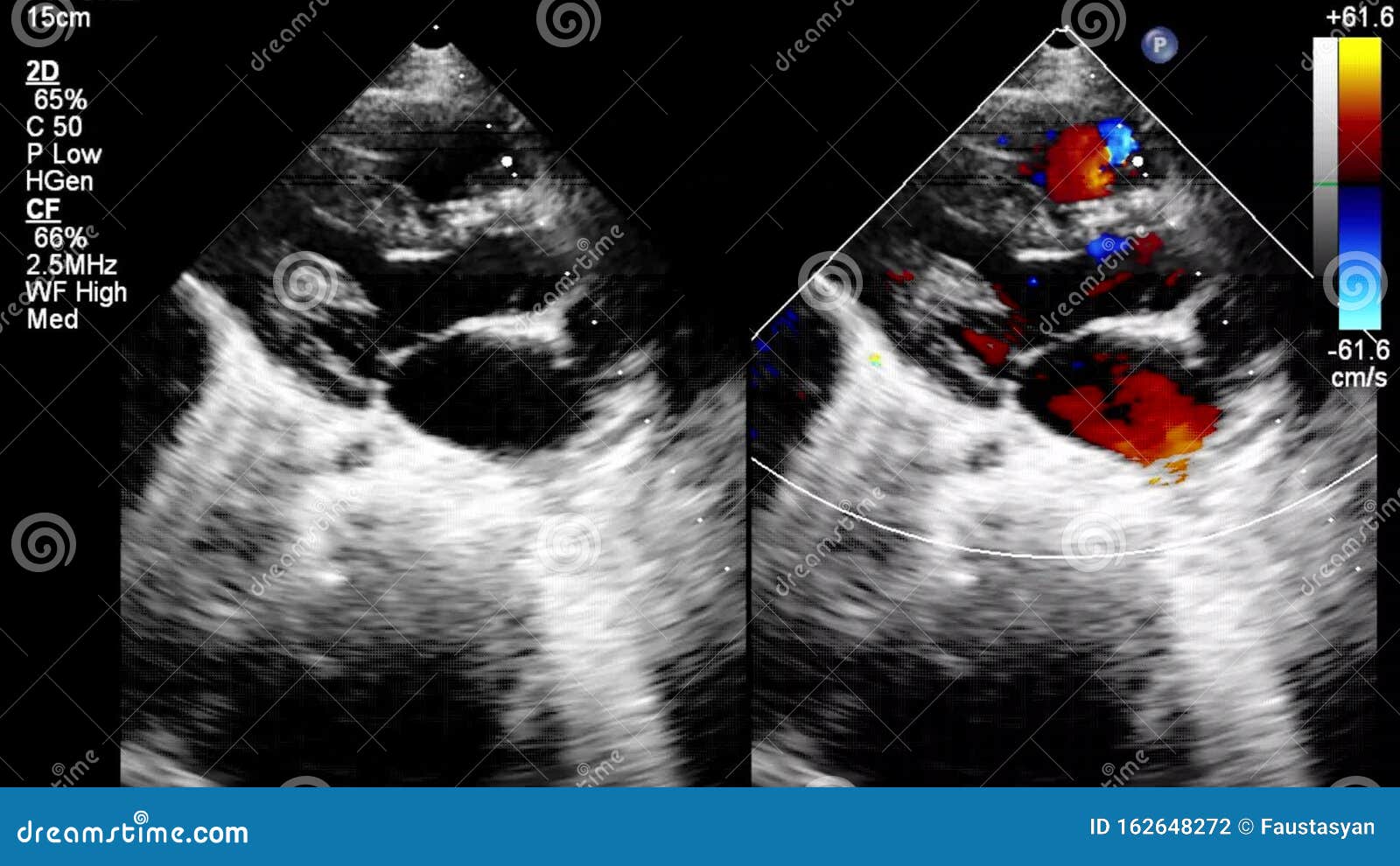 Screen of Echocardiography Ultrasound Machine Stock Footage - Video of ...