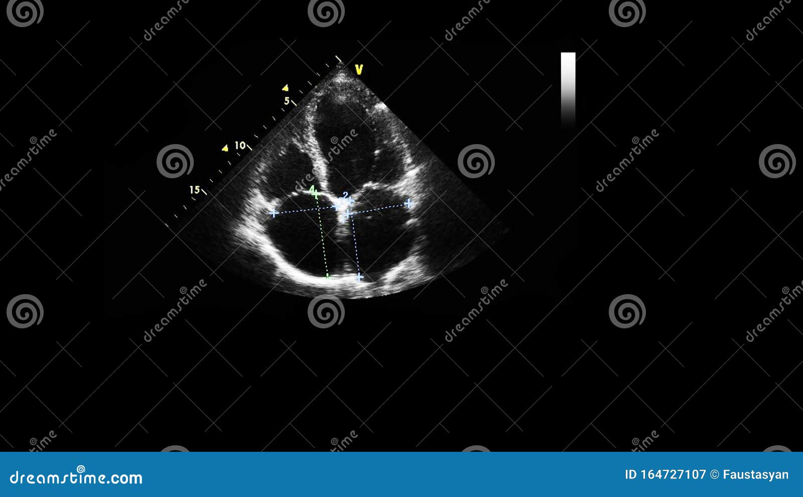 Screen of Echocardiography Ultrasound Machine Stock Image - Image of ...