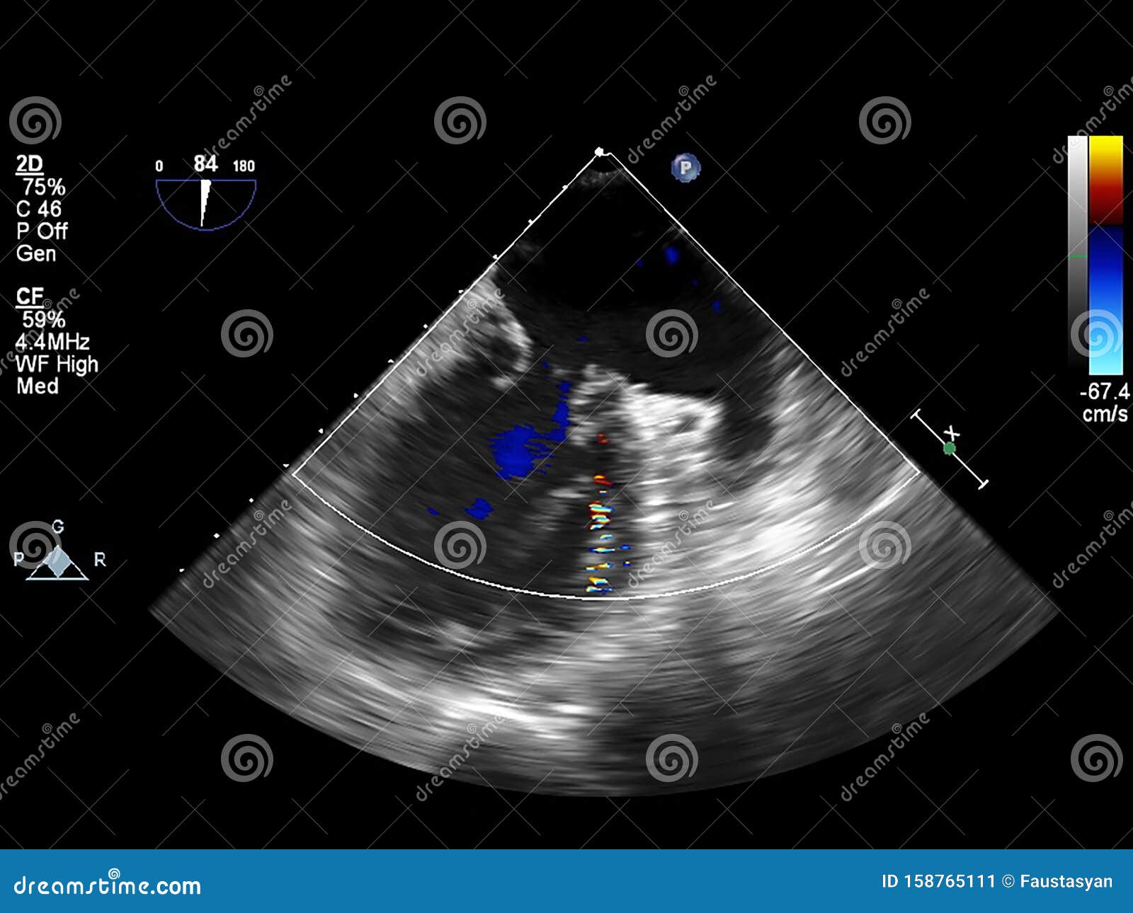 Screen of Echocardiography Ultrasound Machine Stock Image - Image of ...
