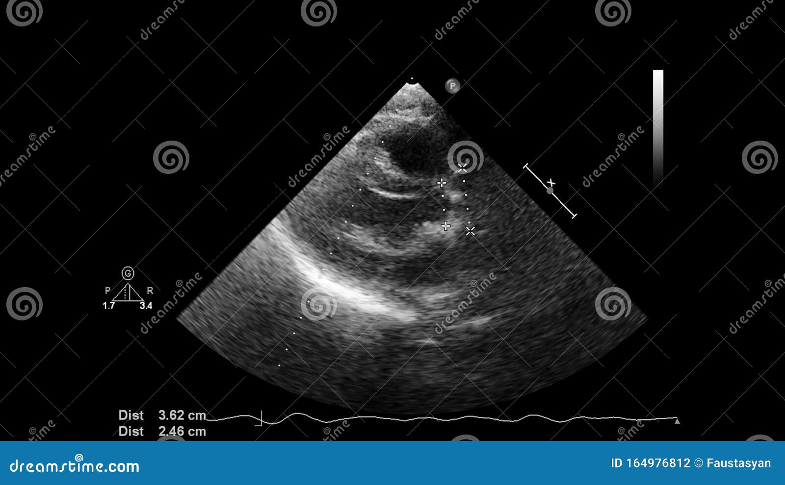 Screen of an Ultrasound Machine with a Heart Image Stock Photo - Image ...