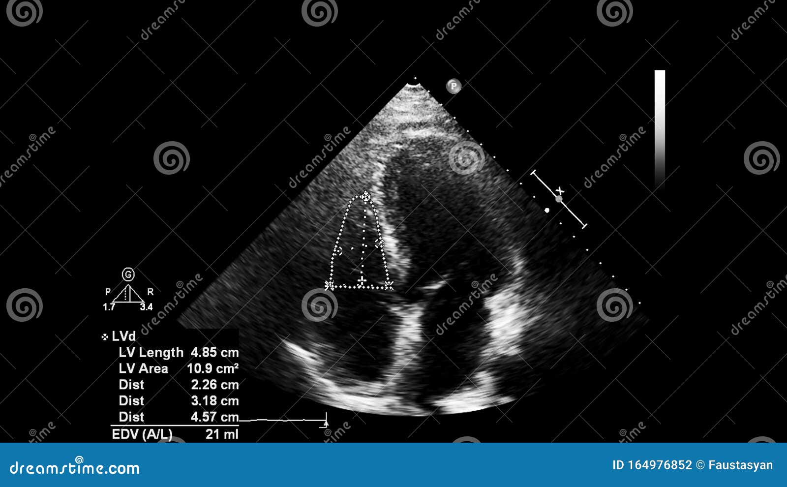 Screen of an Ultrasound Machine with a Heart Image Stock Photo - Image ...