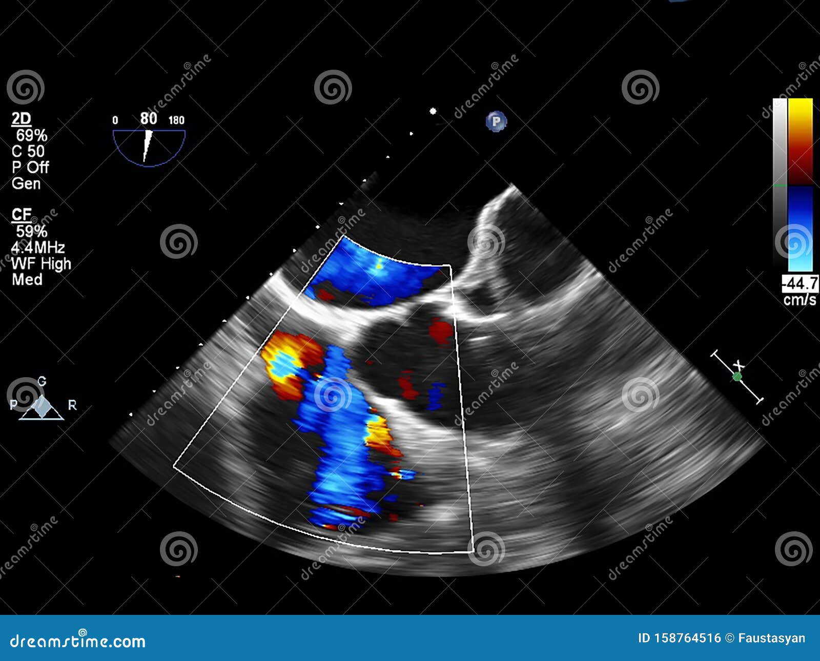 Screen of Echocardiography Ultrasound Machine Stock Photo - Image of ...