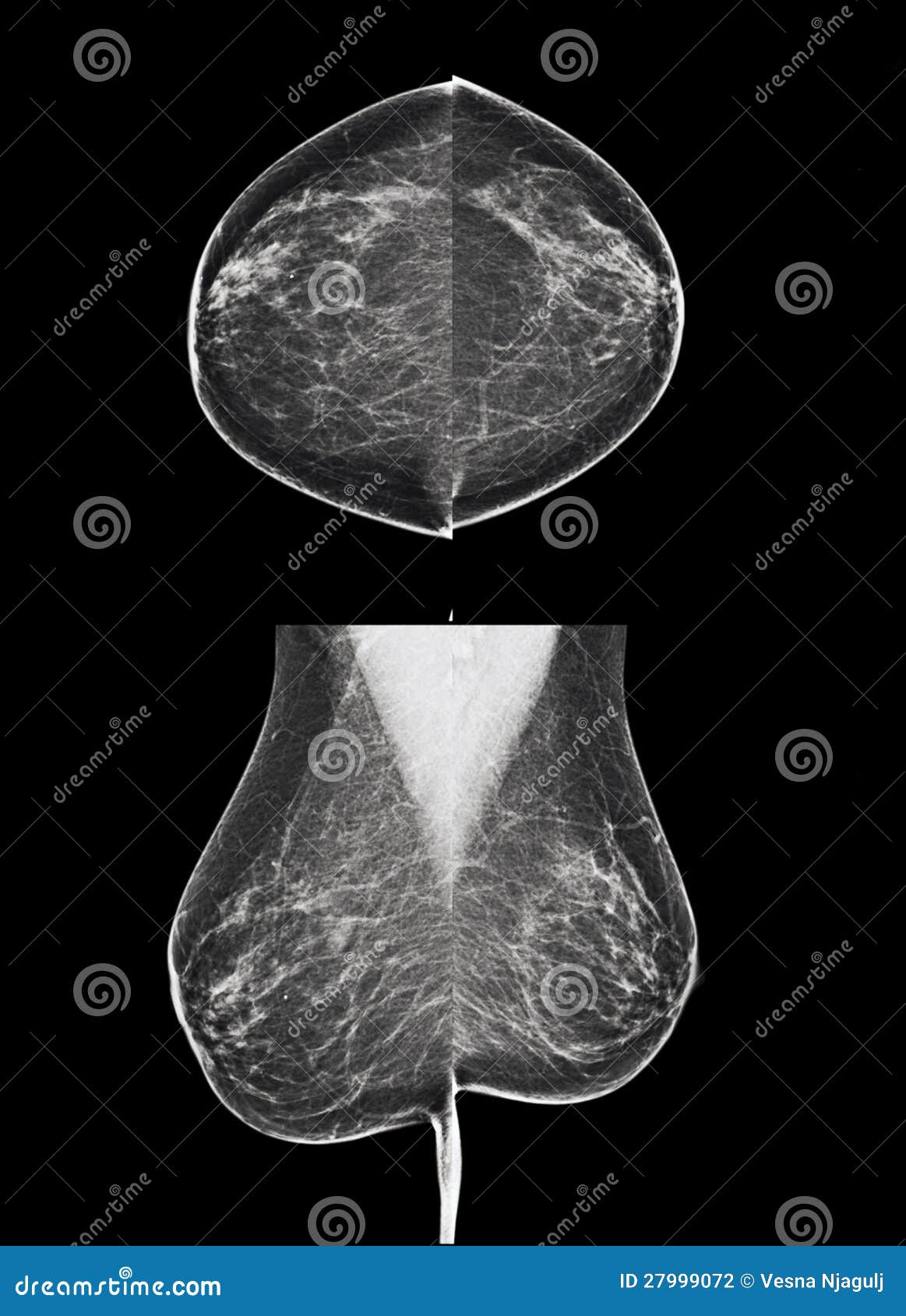 Screening For Breast Cancer - Mammogram Stock Photography - Image: 27999072