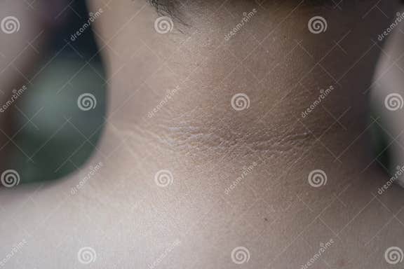 Scurf, Black Marks on the Skin Stock Image - Image of crust, endure ...