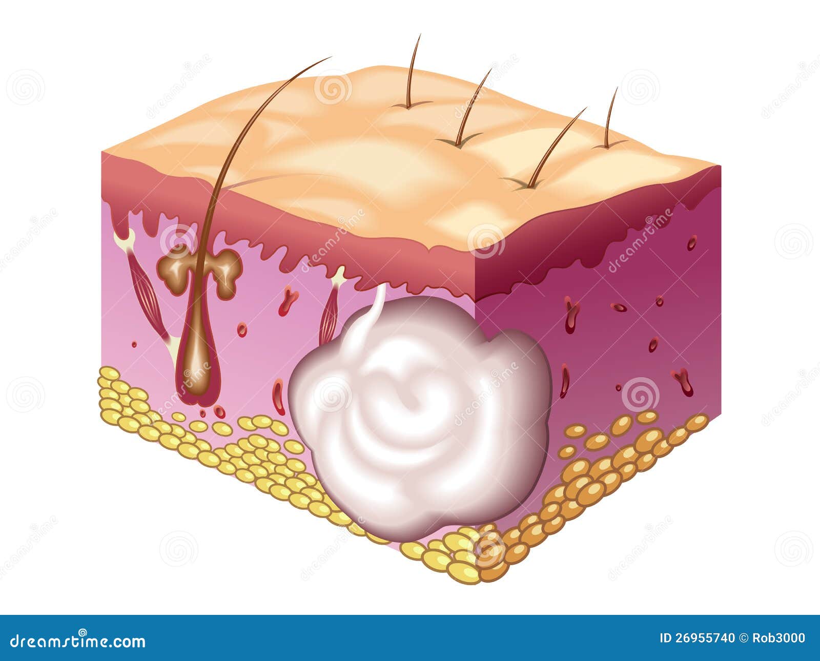 Sebaceous cyste vector illustratie. Illustration of capsule - 26955740