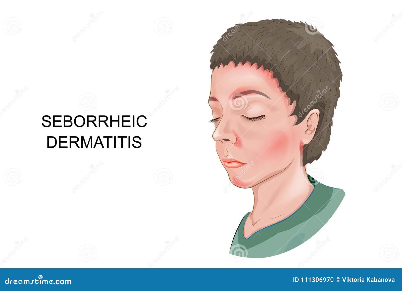 SEBORRHEIC DERMATIT Av Huden Vektor Illustrationer - Illustration av ...