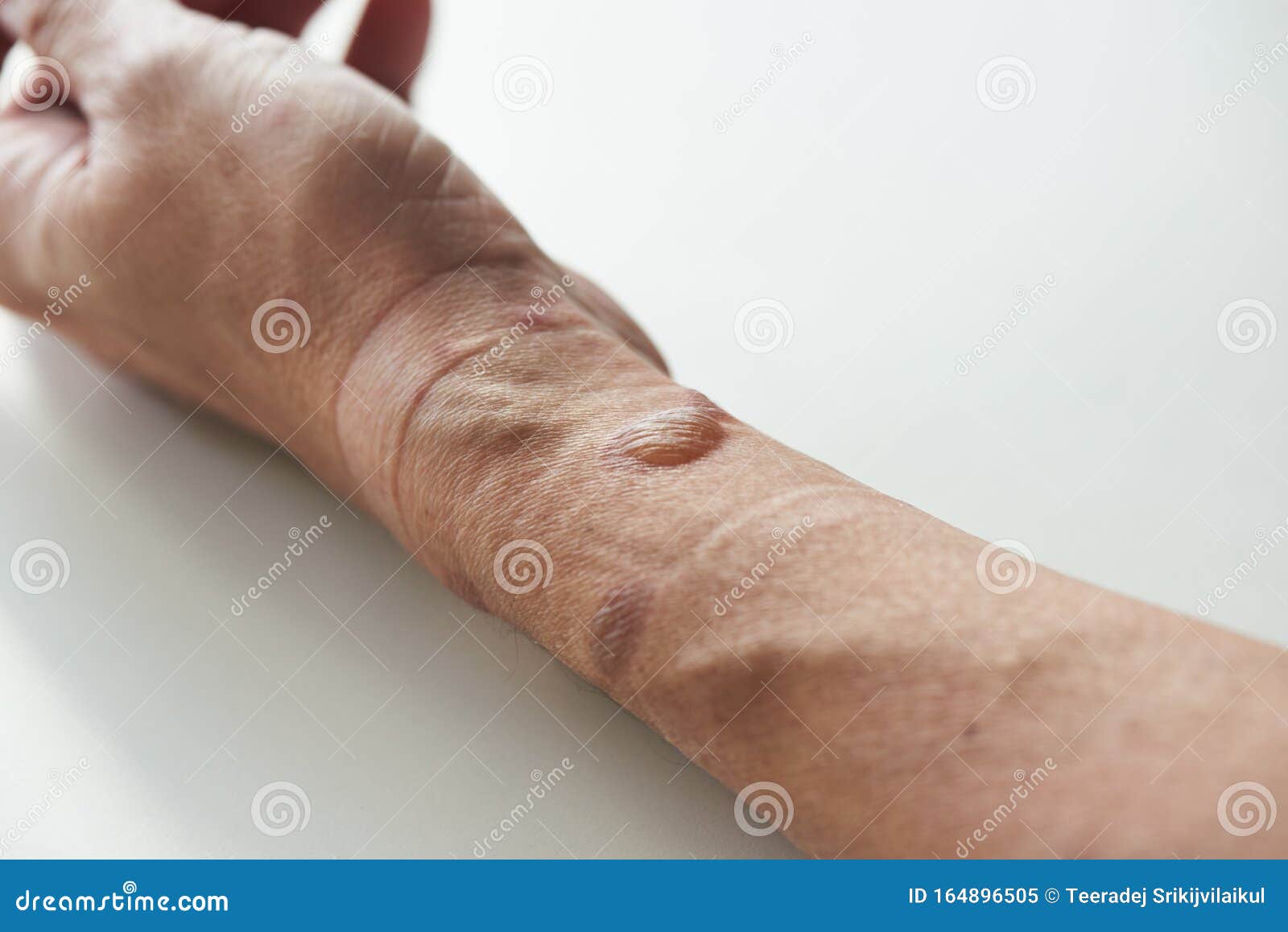 Second Degree Burn at Left Forearm and Wrist Stock Image - Image of ...