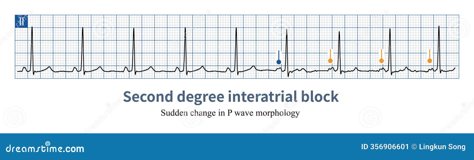 Second Degree Interatrial Block Stock Image - Image of bachmann ...