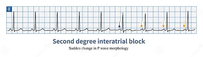 Second Degree Interatrial Block Stock Image - Image of bachmann ...
