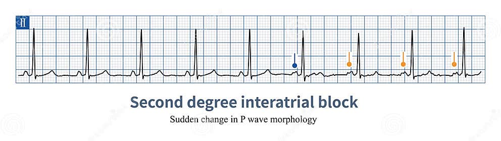 Second Degree Interatrial Block Stock Image - Image of bachmann ...
