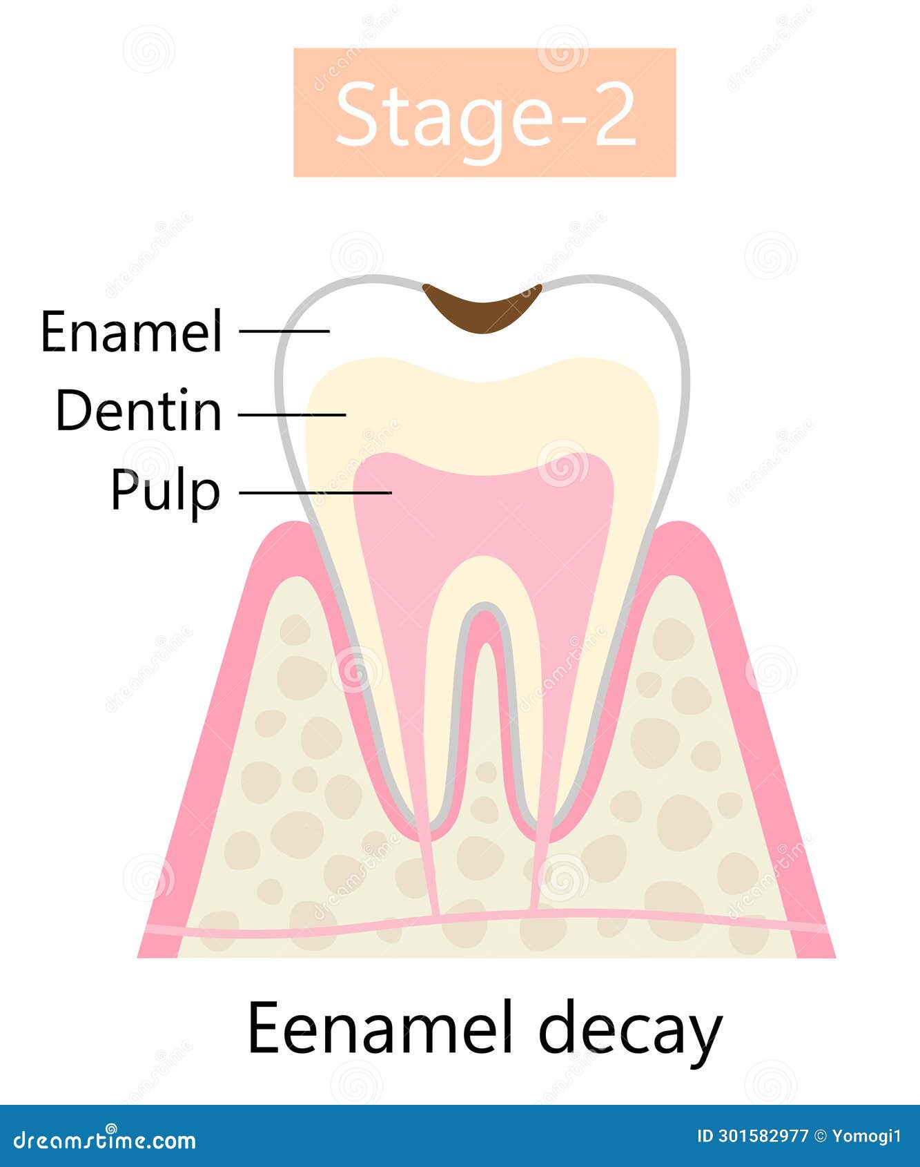 Tooth Decay Symptom, Enamel Decay Results in Dental Cavity Formation ...