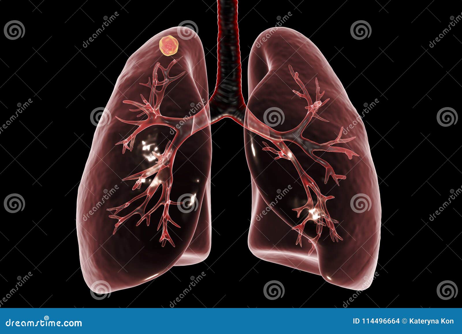 Secondary Tuberculosis in Lungs Stock Illustration - Illustration of ...